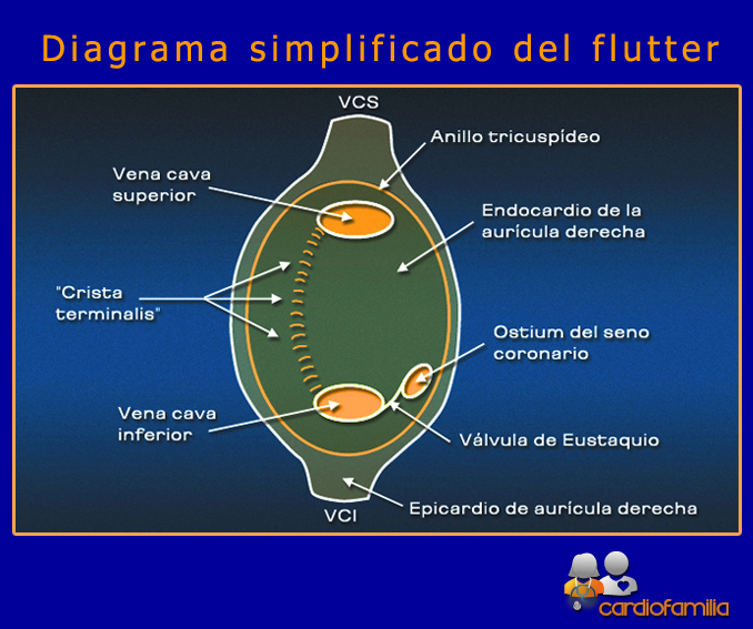 Etiología, clínica y tratamiento del flutter auricular